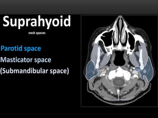 IMAGING ANATOMY OF SUPRAHYOID NECK SPACES copy.pptx