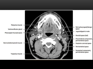 IMAGING ANATOMY OF SUPRAHYOID NECK SPACES copy.pptx