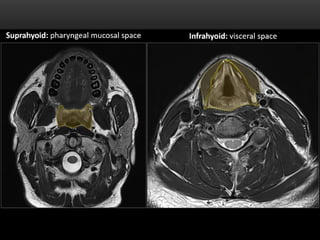 IMAGING ANATOMY OF SUPRAHYOID NECK SPACES copy.pptx