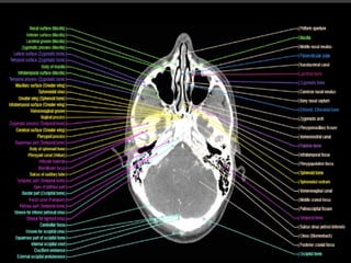IMAGING ANATOMY OF SUPRAHYOID NECK SPACES copy.pptx