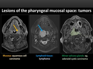 IMAGING ANATOMY OF SUPRAHYOID NECK SPACES copy.pptx