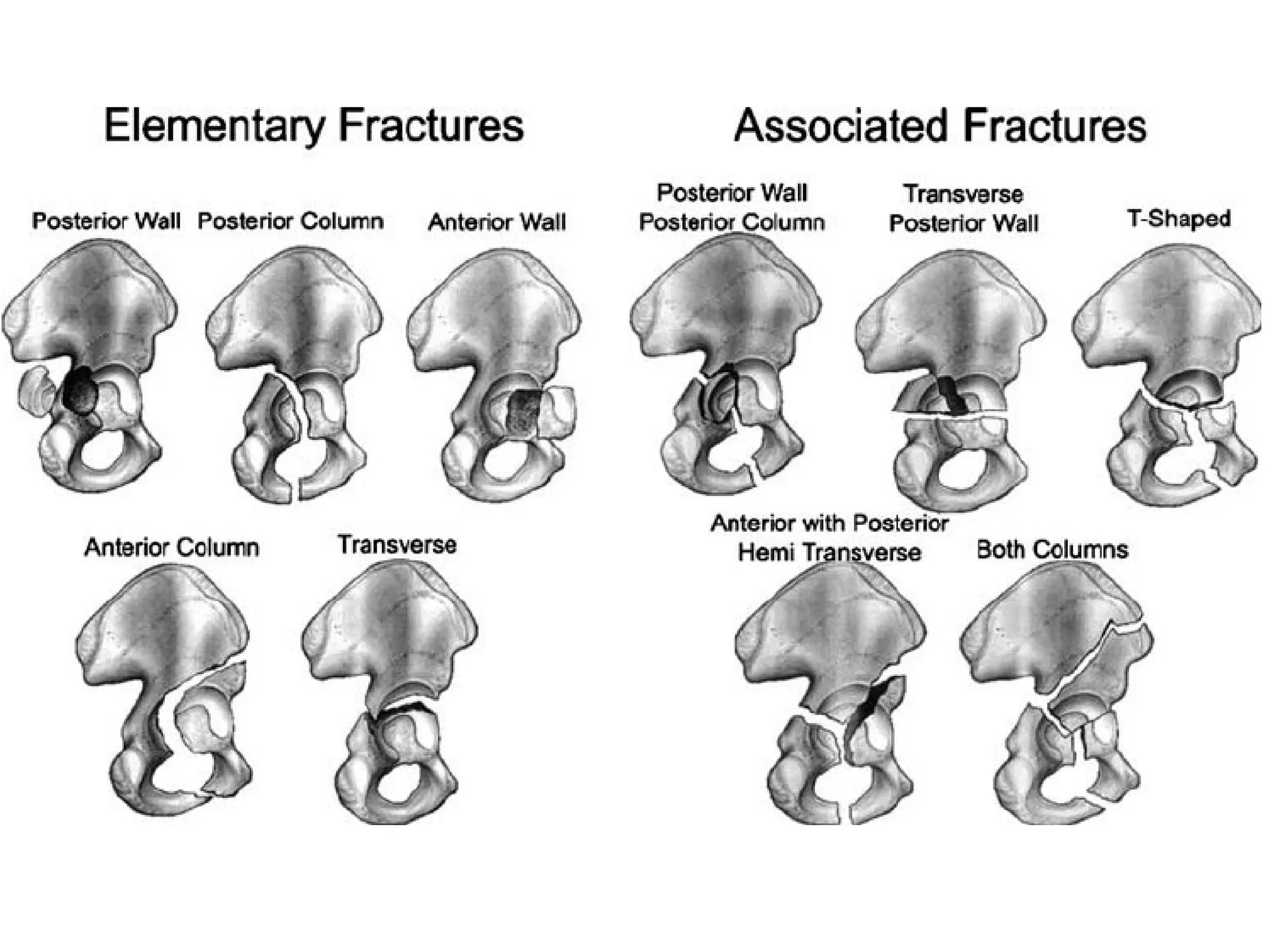 IMAGING AND CLASSIFICATION OF ACETABULAR FRACTURES.pptx