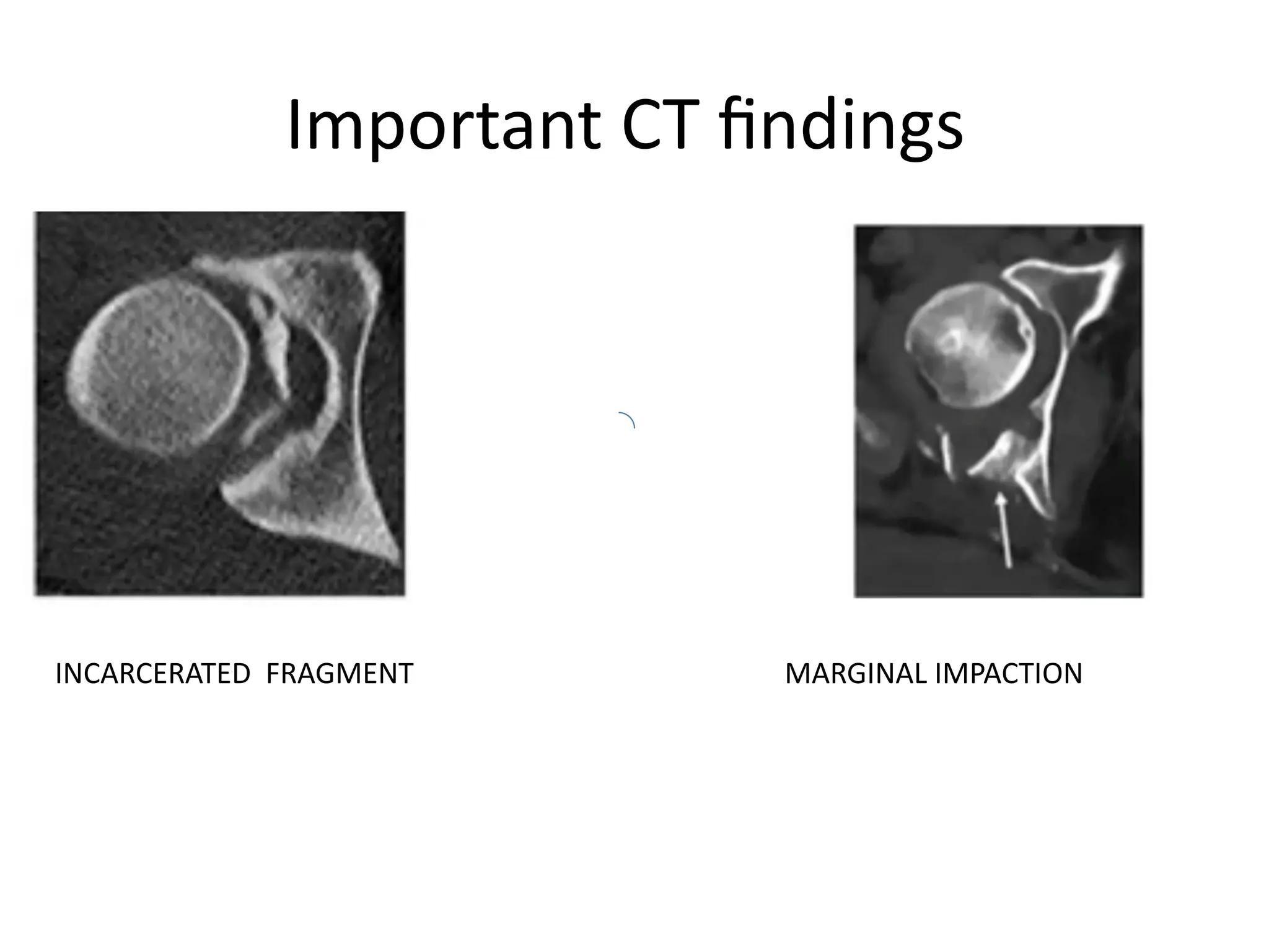 IMAGING AND CLASSIFICATION OF ACETABULAR FRACTURES.pptx