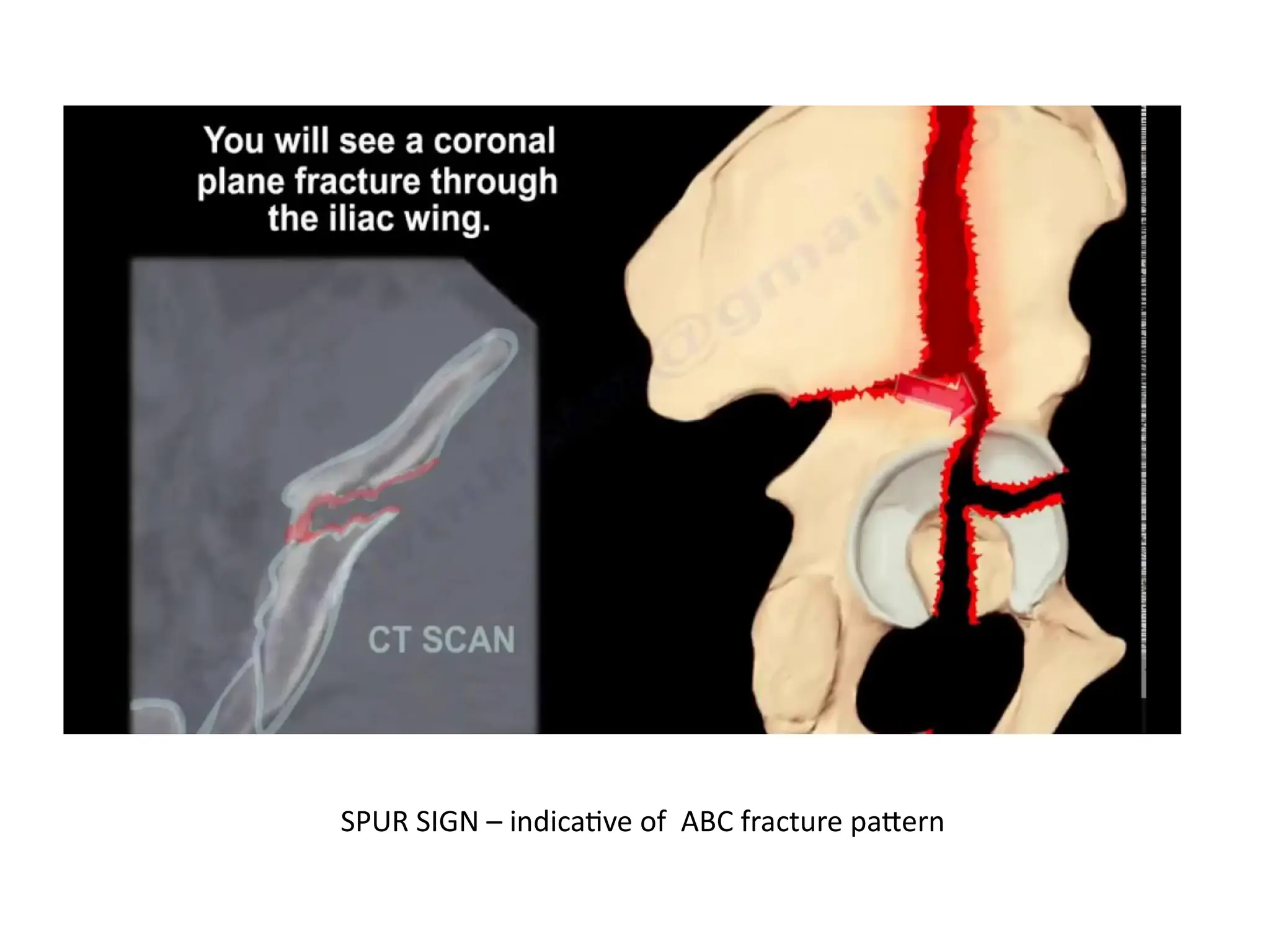 IMAGING AND CLASSIFICATION OF ACETABULAR FRACTURES.pptx