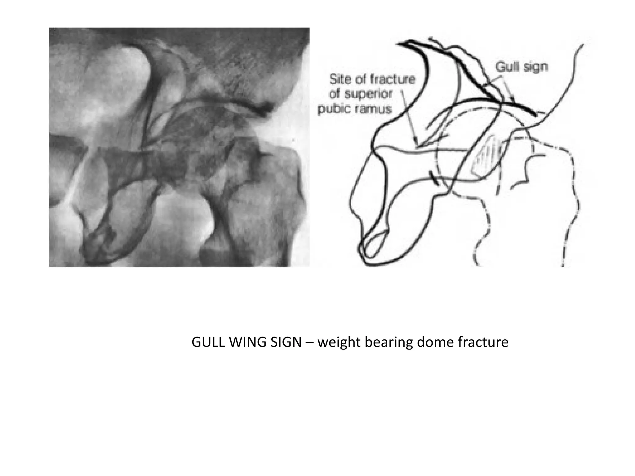 IMAGING AND CLASSIFICATION OF ACETABULAR FRACTURES.pptx