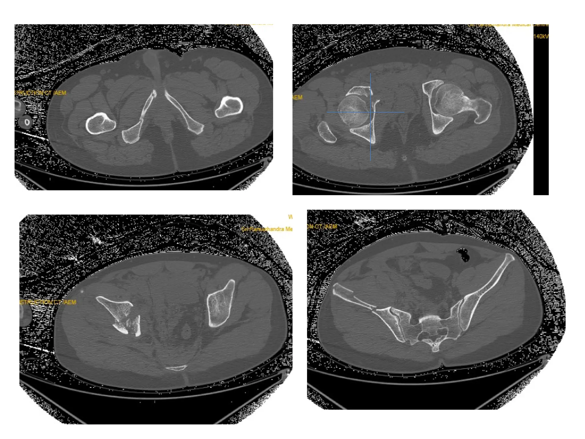 IMAGING AND CLASSIFICATION OF ACETABULAR FRACTURES.pptx