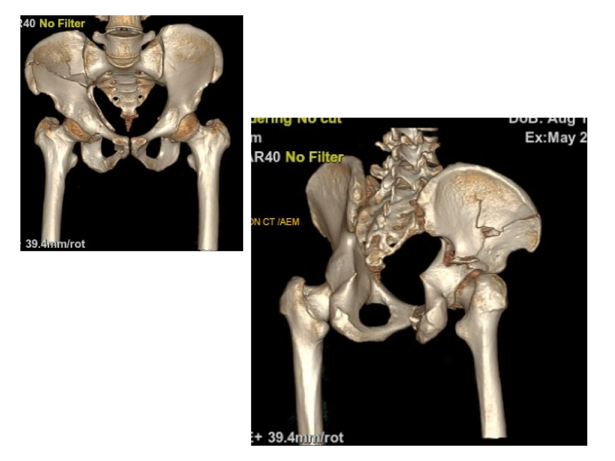 IMAGING AND CLASSIFICATION OF ACETABULAR FRACTURES.pptx