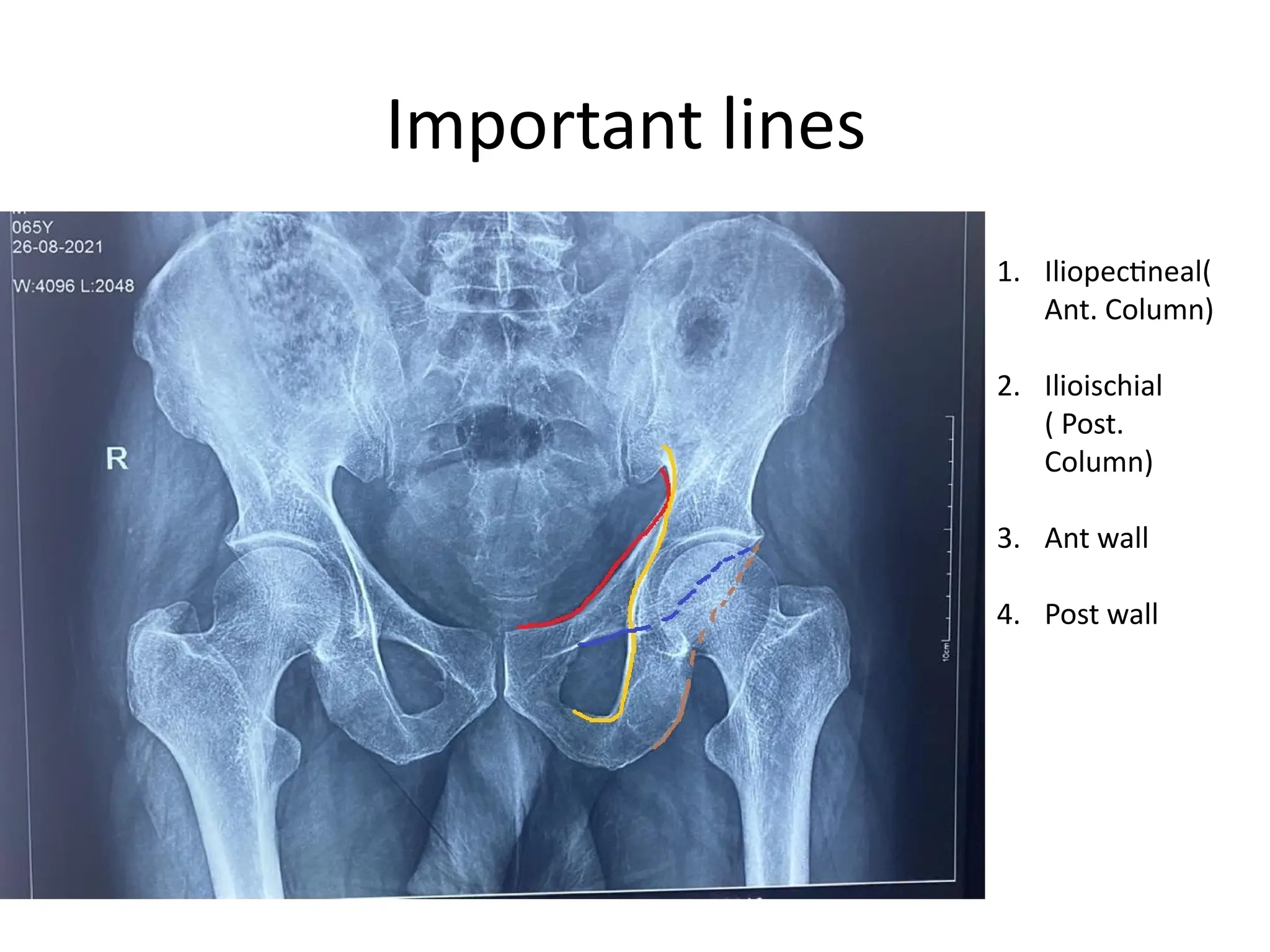 IMAGING AND CLASSIFICATION OF ACETABULAR FRACTURES.pptx