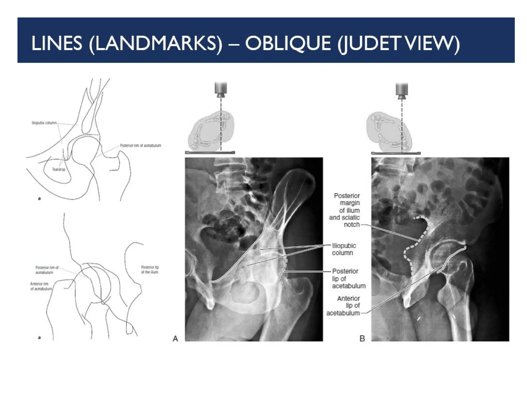 IMAGING AND CLASSIFICATION OF ACETABULAR FRACTURES.pptx