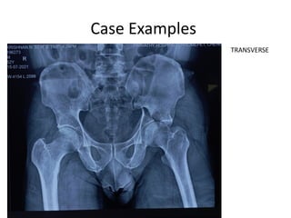 IMAGING AND CLASSIFICATION OF ACETABULAR FRACTURES.pptx
