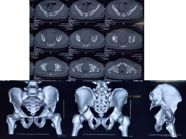 IMAGING AND CLASSIFICATION OF ACETABULAR FRACTURES.pptx