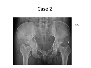 IMAGING AND CLASSIFICATION OF ACETABULAR FRACTURES.pptx