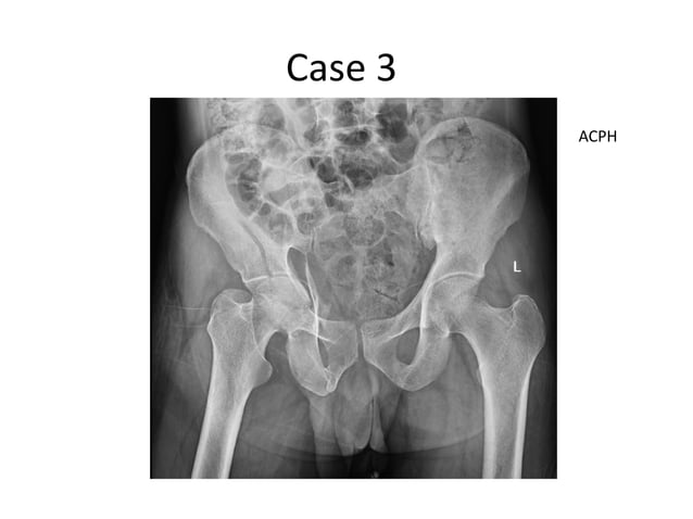 IMAGING AND CLASSIFICATION OF ACETABULAR FRACTURES.pptx