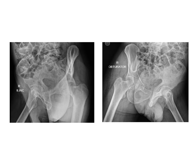 IMAGING AND CLASSIFICATION OF ACETABULAR FRACTURES.pptx