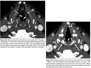 Imaging and pathology of larynx (2) | PPTX