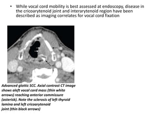 Imaging and pathology of larynx (2) | PPTX