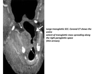 Imaging and pathology of larynx (2) | PPTX