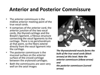 Posterior Commissure Larynx