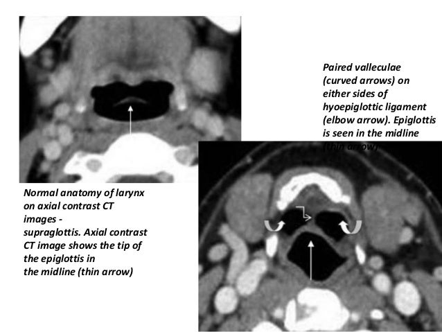 Imaging and pathology of larynx (2)