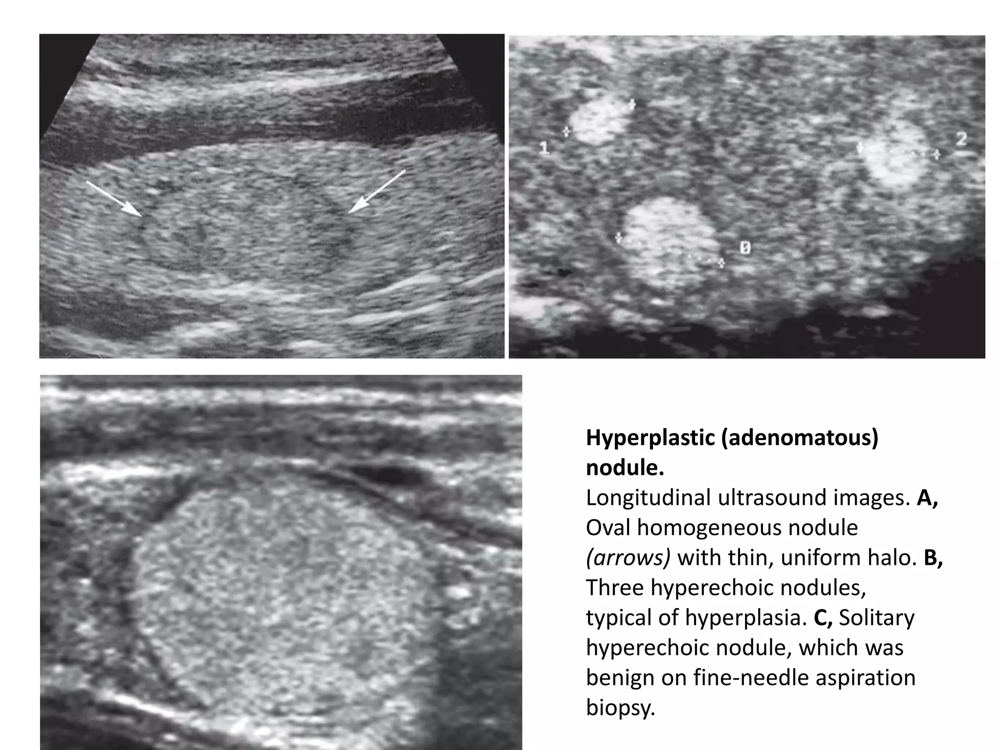 Imaging approach in thyroid nodules | PPTX
