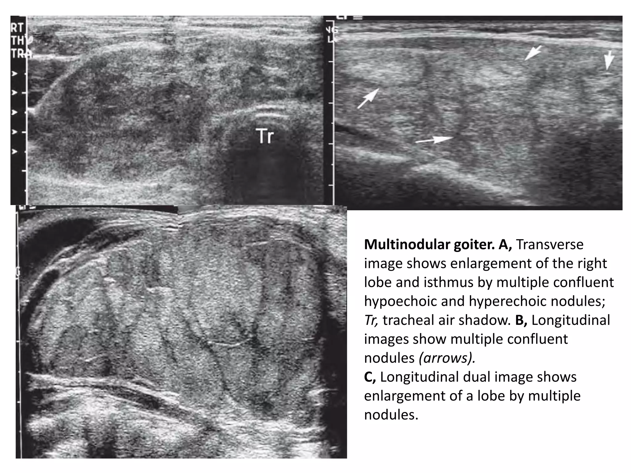 Imaging approach in thyroid nodules | PPTX
