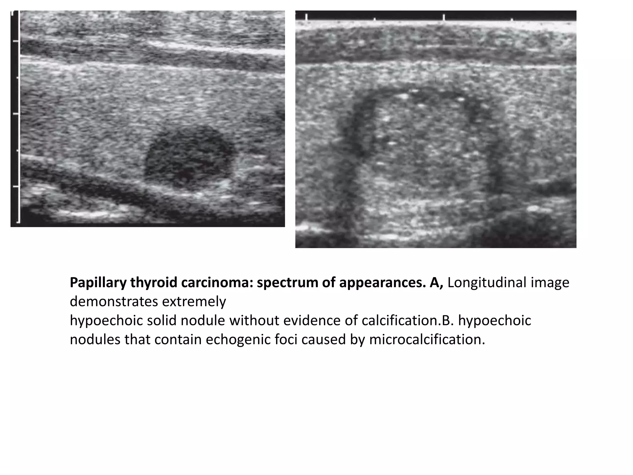 Imaging approach in thyroid nodules | PPTX