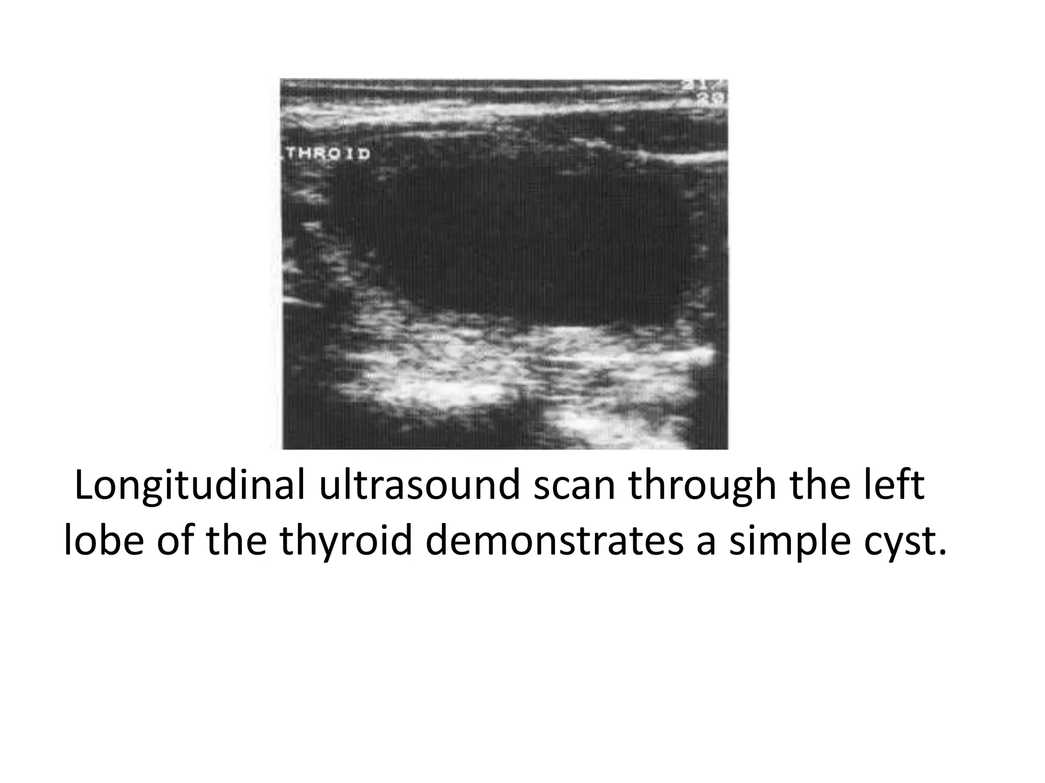 Imaging approach in thyroid nodules | PPTX