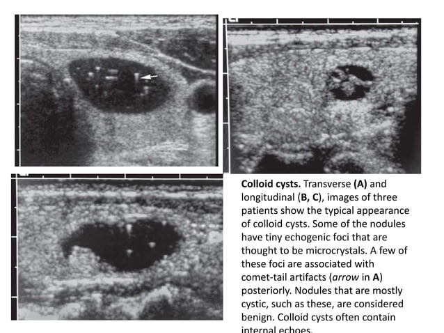 Imaging approach in thyroid nodules | PPTX