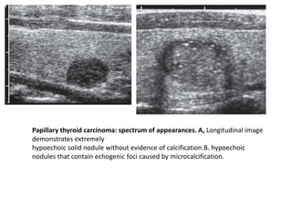 Imaging approach in thyroid nodules | PPTX