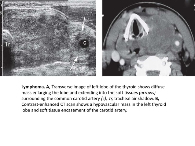 Imaging approach in thyroid nodules | PPTX