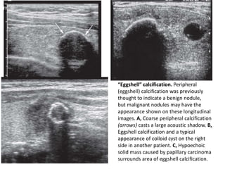 Imaging approach in thyroid nodules | PPTX
