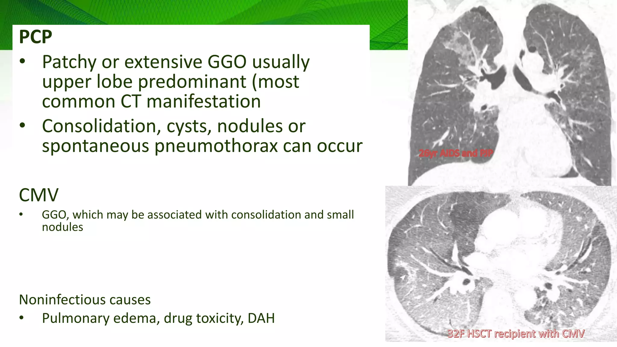 Imaging approach to common respiratory infections in immuno-compromised patients.pptx