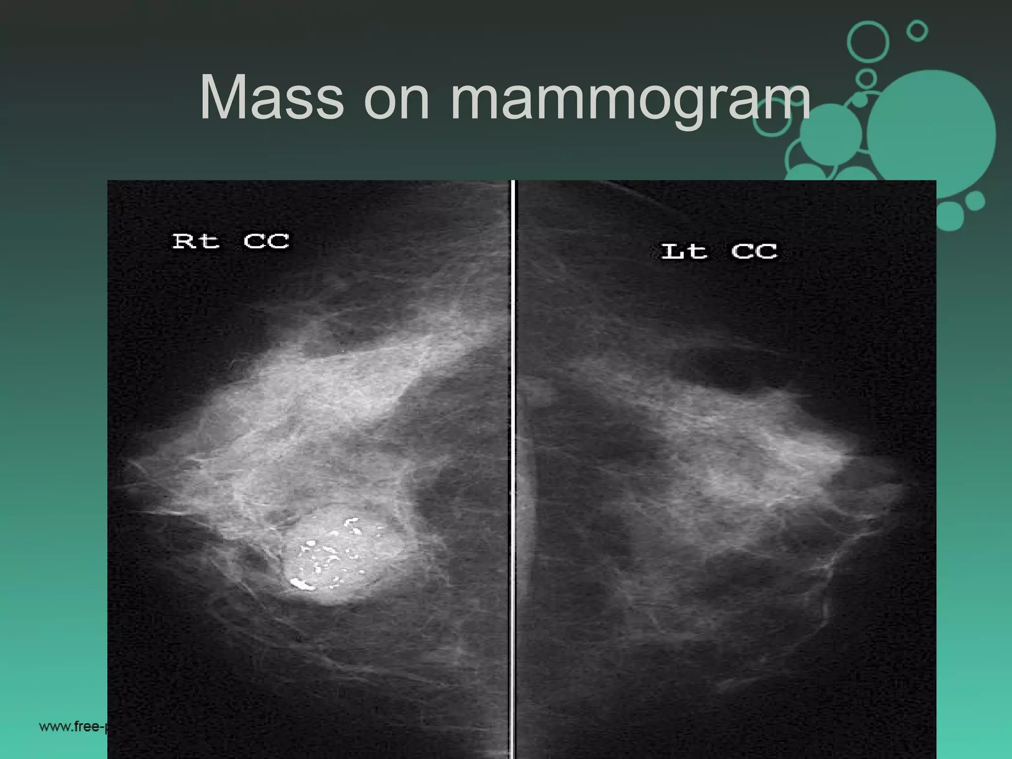 Imaging breast mammogram | PPT
