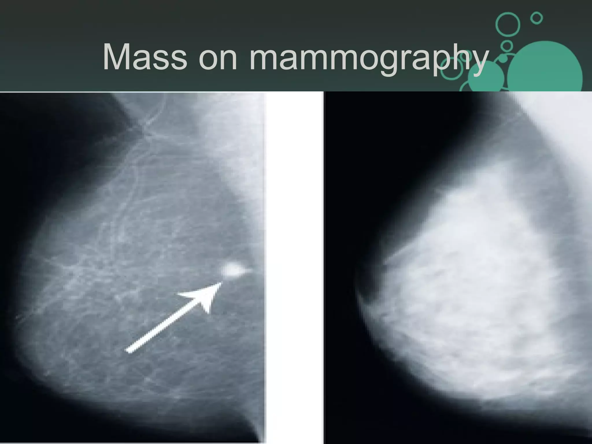 Imaging breast mammogram | PPT