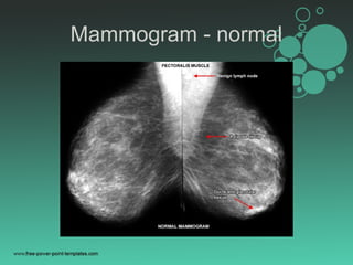 Imaging breast mammogram | PPT