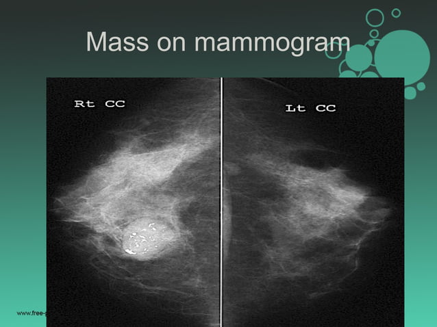 Imaging breast mammogram | PPT