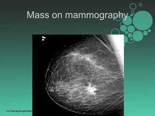 Imaging breast mammogram | PPT