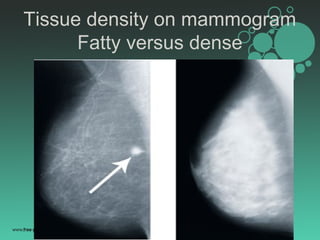 Imaging breast mammogram | PPT