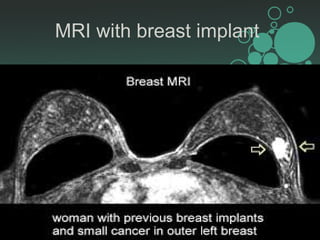Imaging breast mammogram | PPT
