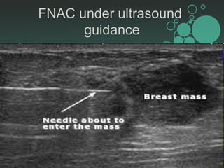 Imaging breast mammogram | PPT