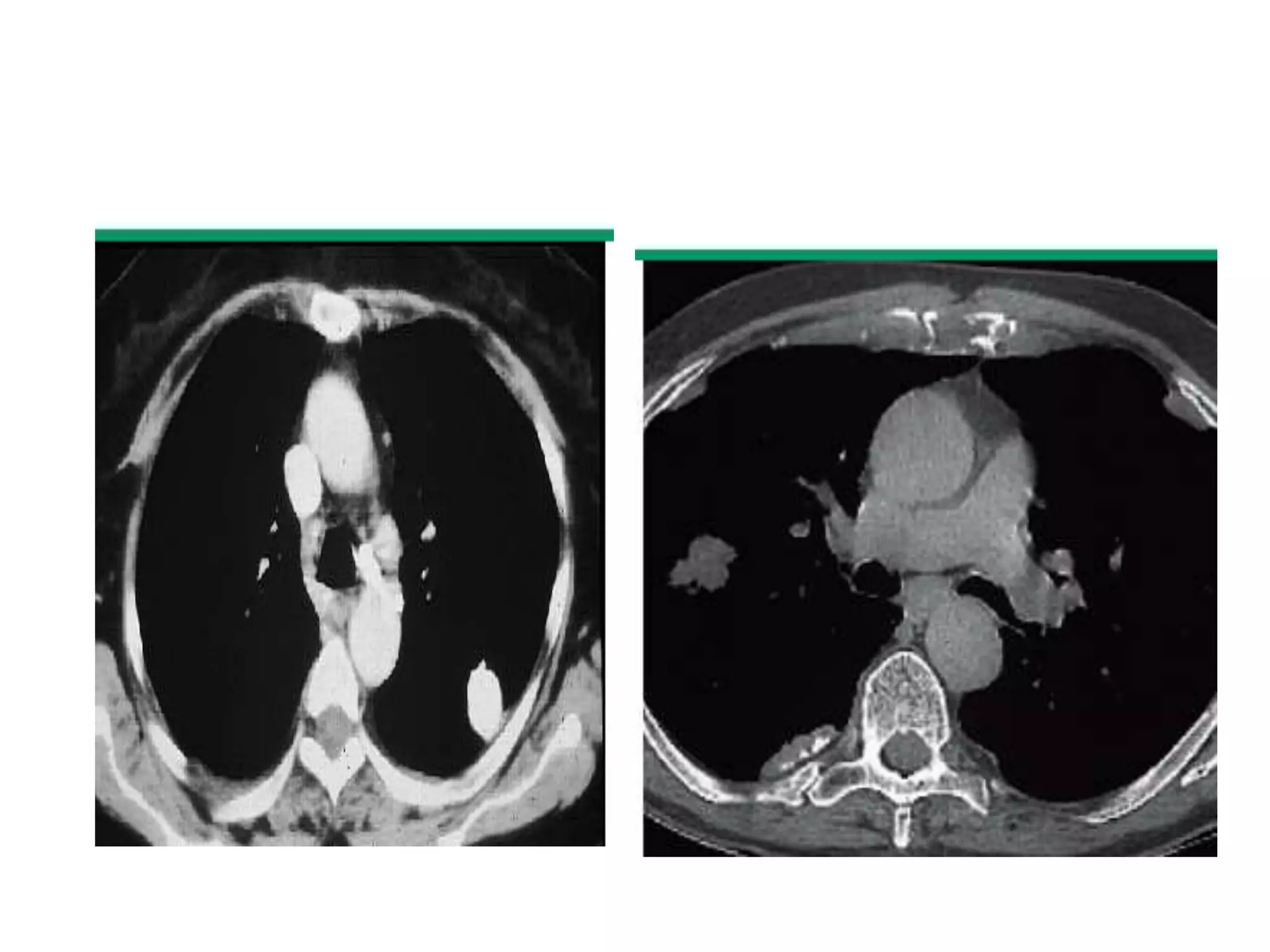 Interpretation of chest CT | PPTX