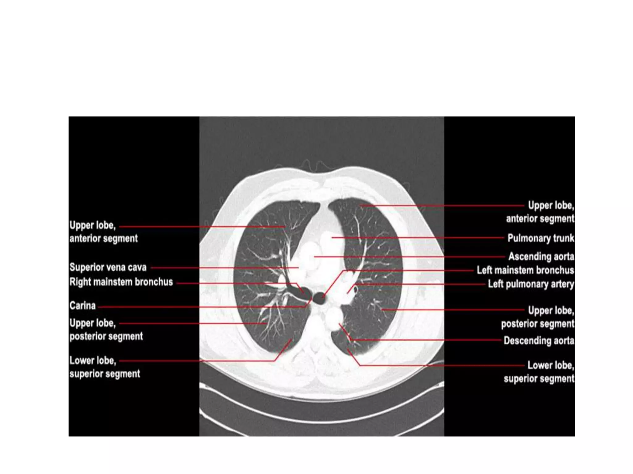 Interpretation of chest CT | PPTX