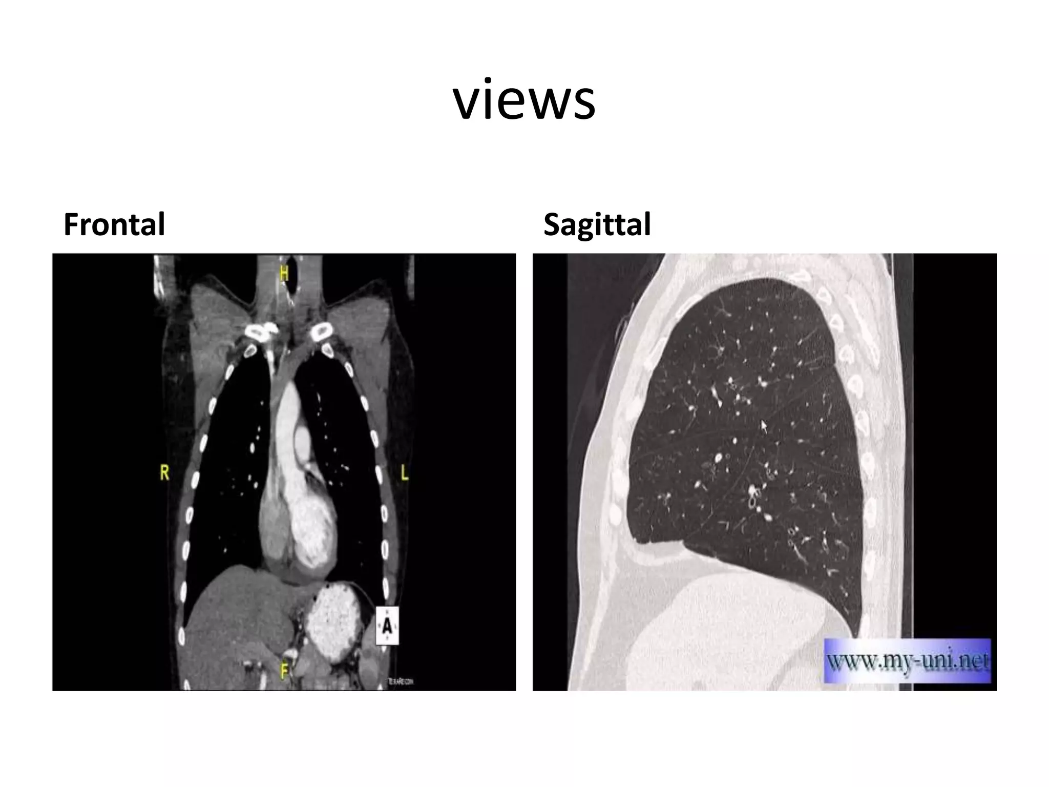 Interpretation of chest CT | PPTX
