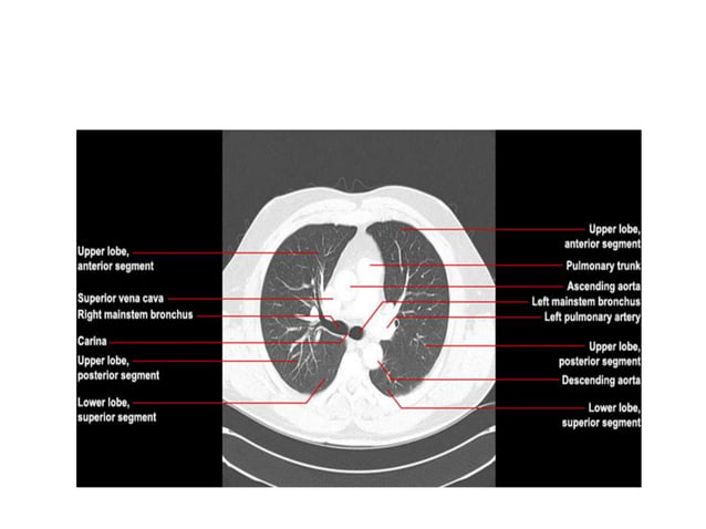 Interpretation of chest CT | PPT