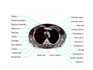 Interpretation of chest CT | PPT