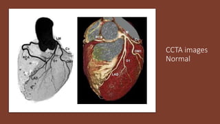 IMAGING CT CORONARY.pptx