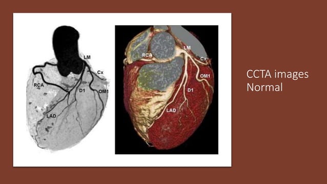 IMAGING CT CORONARY.pptx