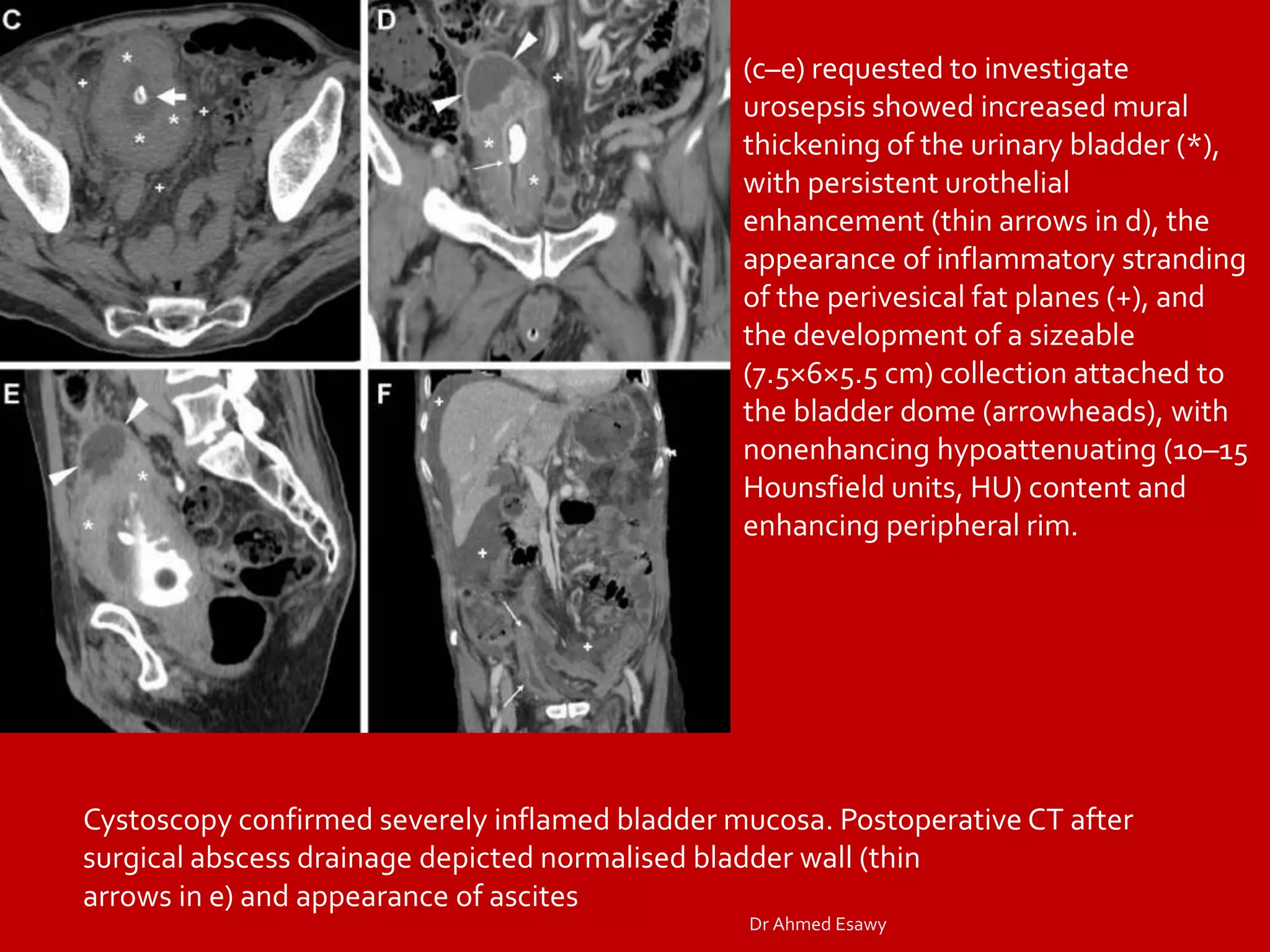 Imaging cystitis Dr Ahmed Esawy | PDF