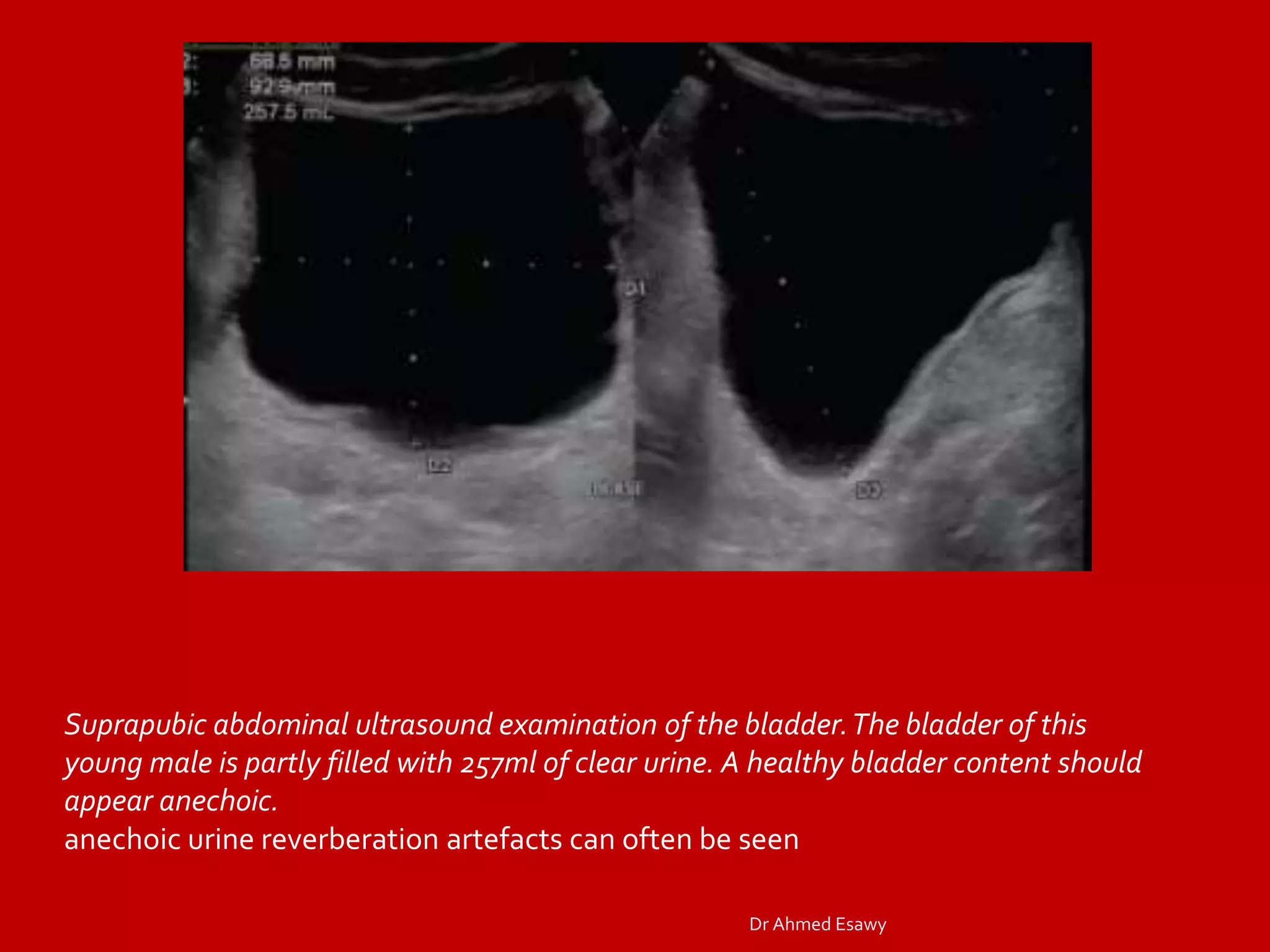 Imaging cystitis Dr Ahmed Esawy | PDF
