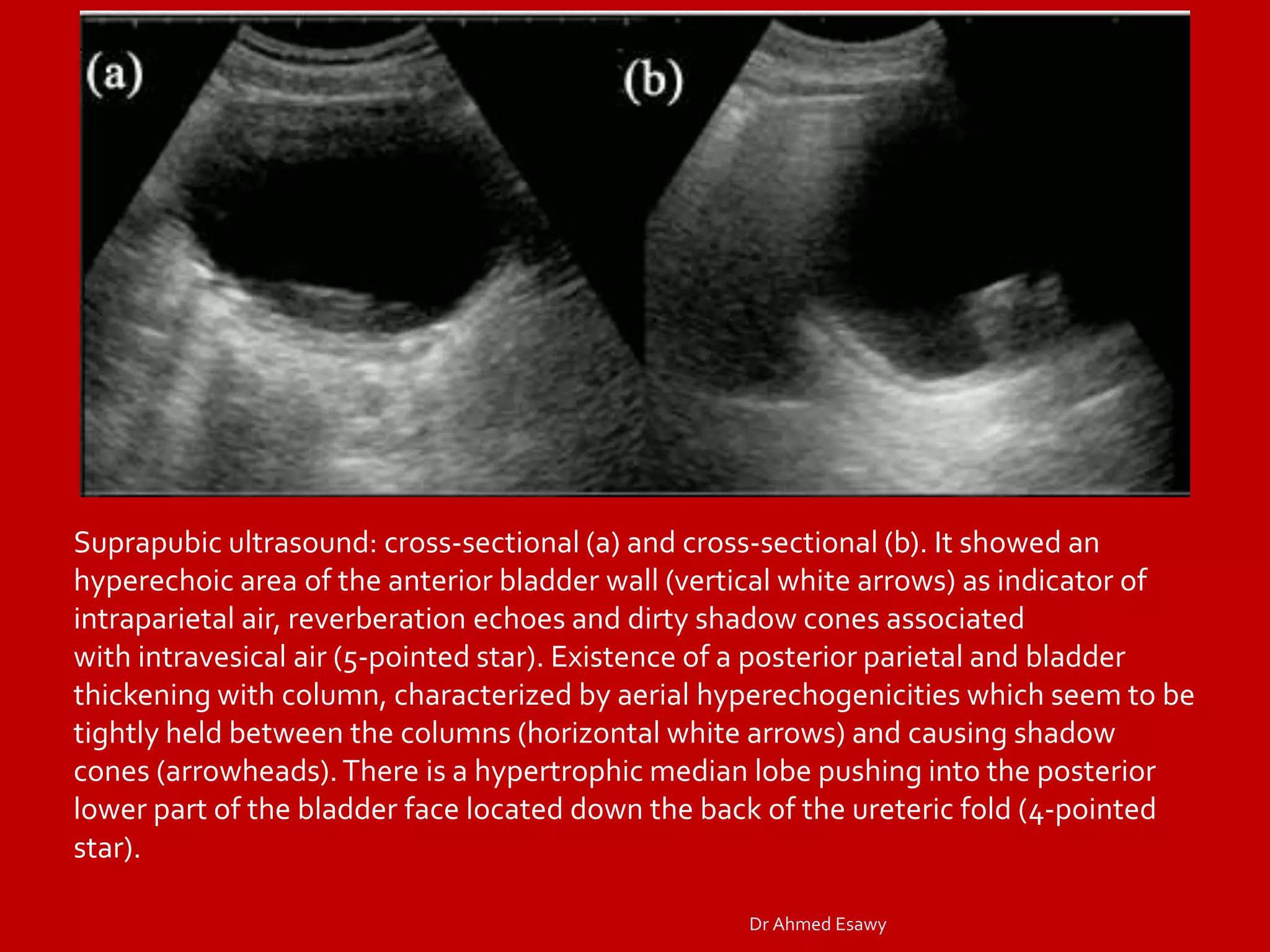 Imaging cystitis Dr Ahmed Esawy | PDF